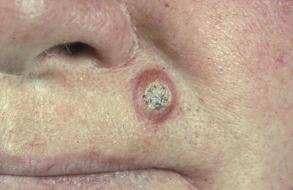 Facial Skin Cancer Facial Skin Cancer