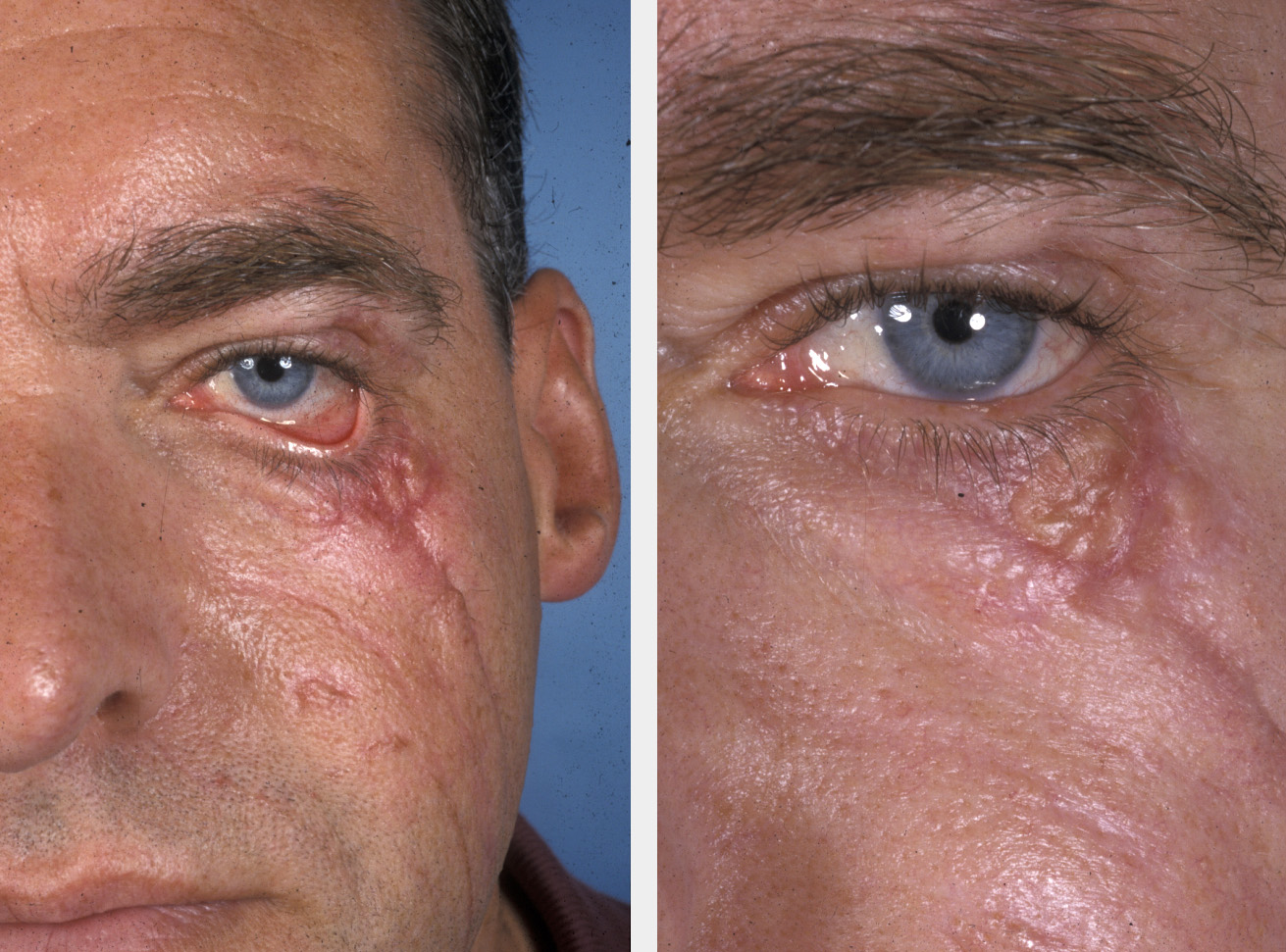 Skin Cancer Of Face Skin Cancer Of Face